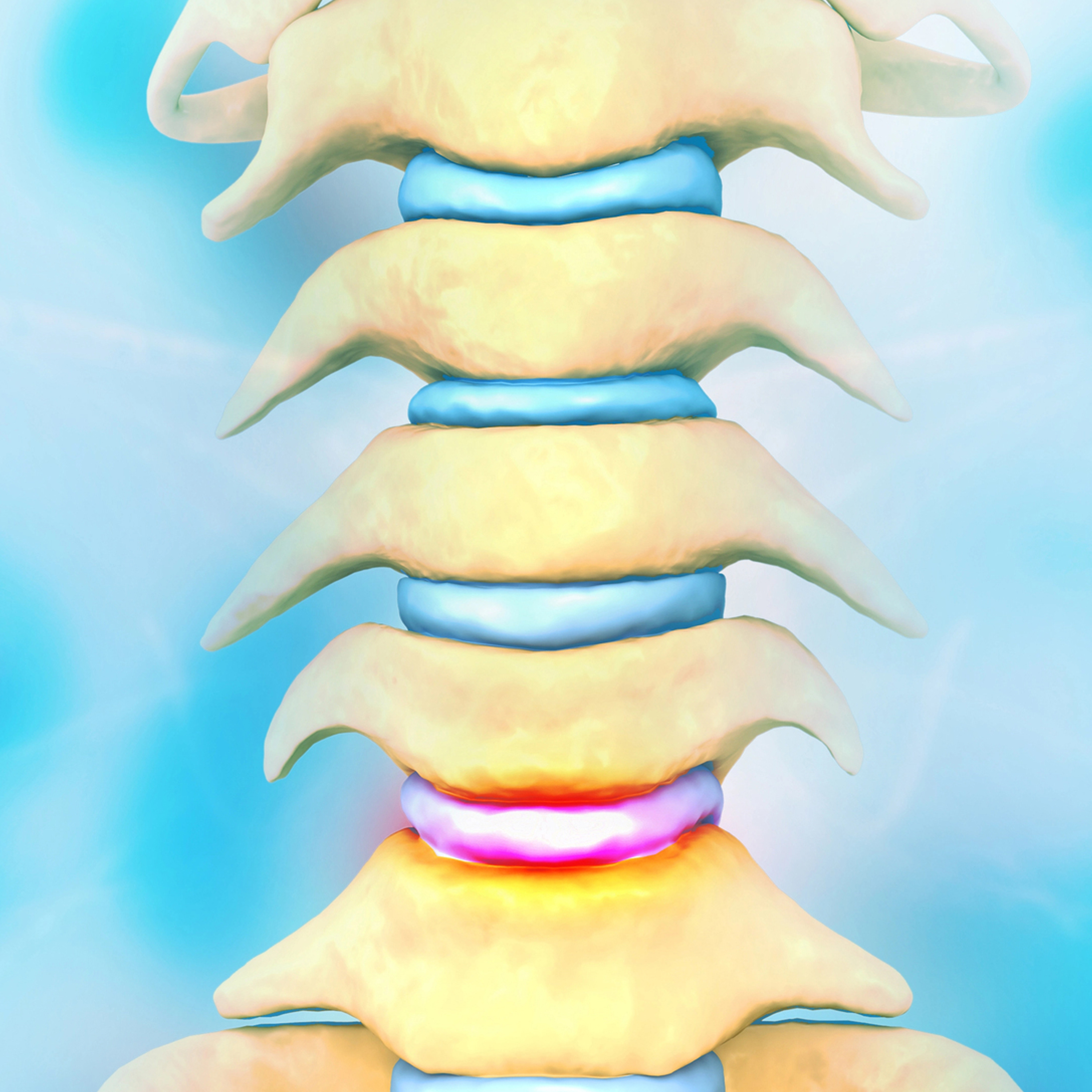 Innovative Approaches to Nashua Spinal Health and Disc Degeneration ...
